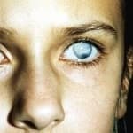 Leukoma - causes and treatment of the eye disease. We have the best ...